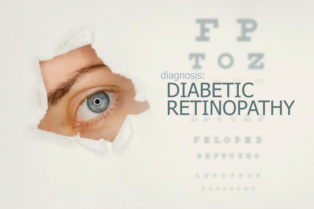 Understanding the Four Stages of Diabetic Retinopathy - Hecht Eye Institute